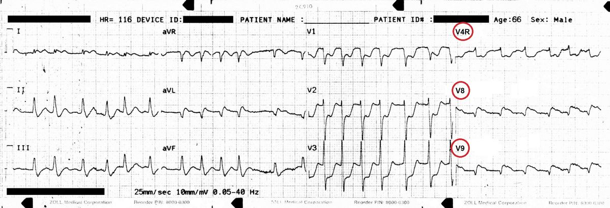 ECG Solution: Mirror on the wall