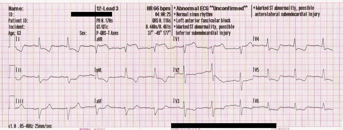 ECG Solution: Just a little depression
