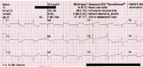 ECG Solution: Just a little depression