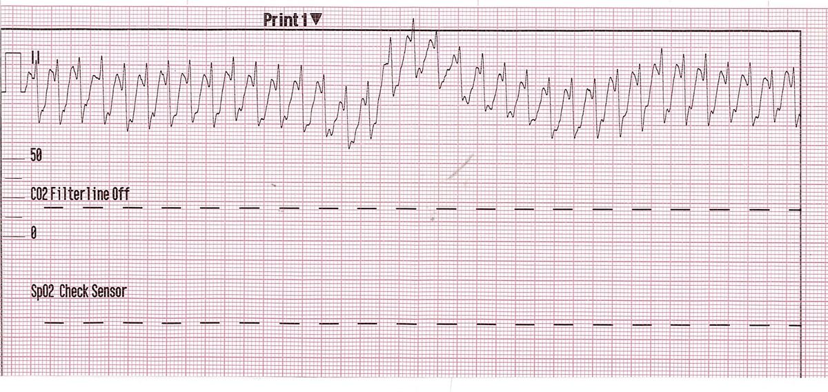 Irregular Heart Rhythm Strips