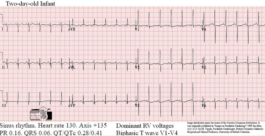 Introduction to pediatric ECG