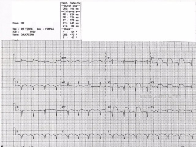 12-Lead ECG Case: A Tale Of Too Many Q Waves