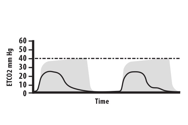 Capnography best practices to improve patient handoff reports