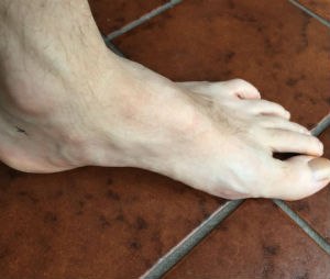 Pedal pulse: Follow these tips to find a pedal pulse (foot pulse)