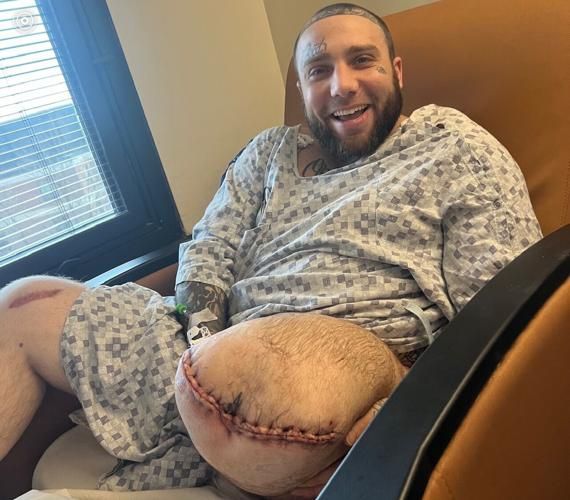 Iowa man grateful for fire, EMS crews that assisted in on-site amputation