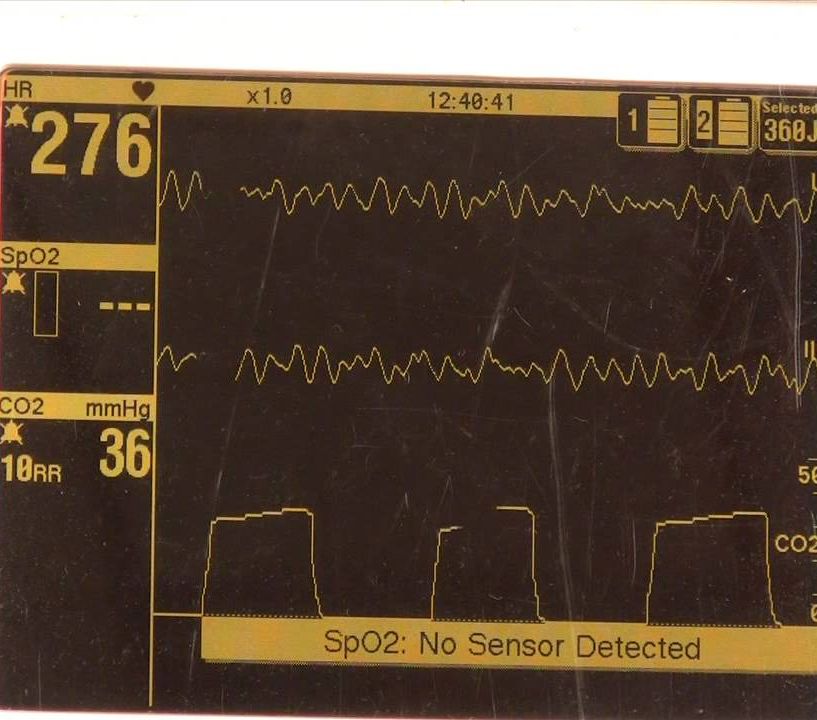 EMS waveform capnography, EtCO2 pitfalls