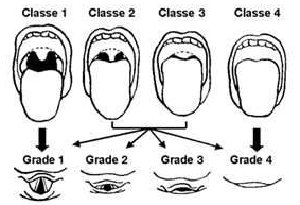 Airway Class vs. Airway Grade: Know the distinction