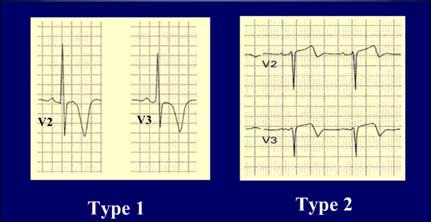 How to assess Wellens' Syndrome | 12- lead EKG case