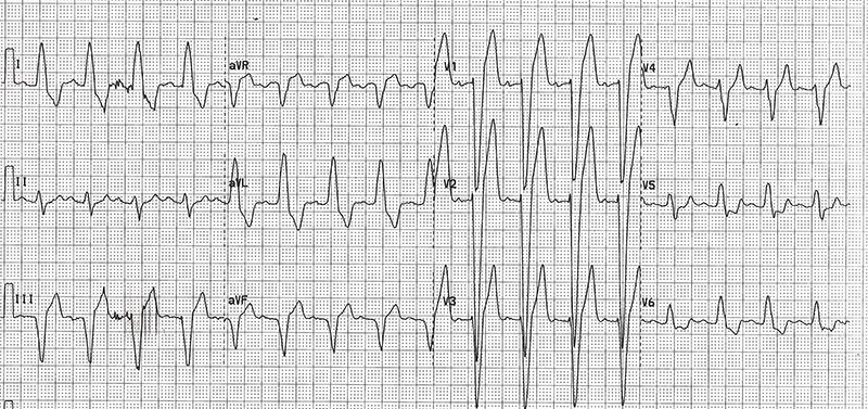12-Lead ECG case: Elderly man presents with CHF, hypertension and dyspnea