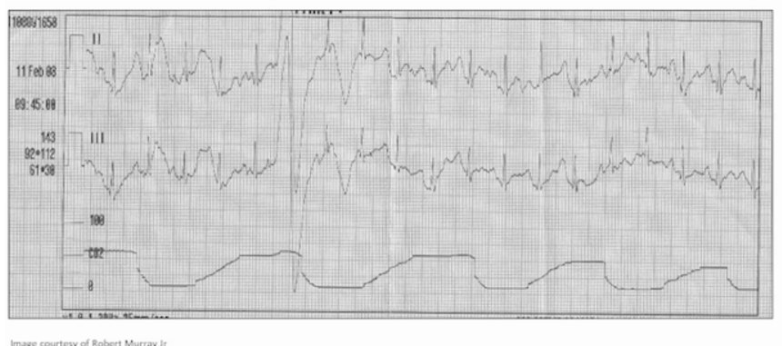 EMS waveform capnography, EtCO2 pitfalls